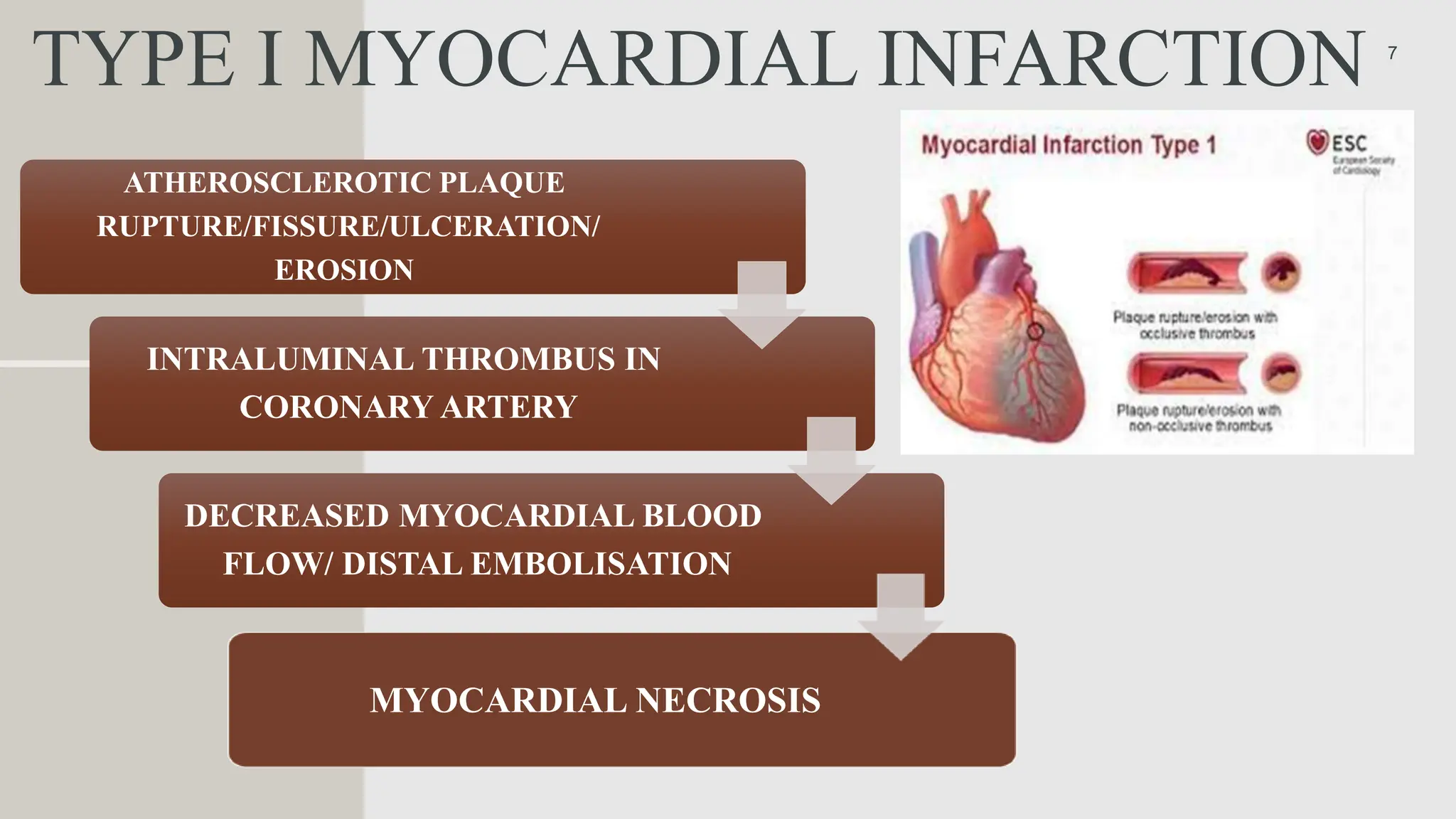 STEMI PPT for acute coronary syndome acute MI | PPTX