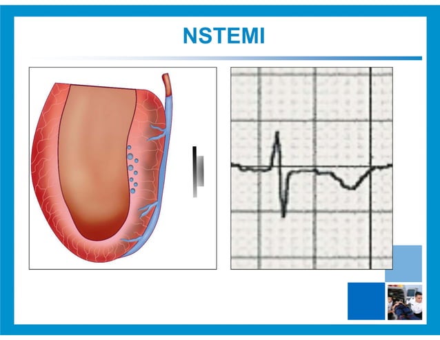STEMI Training | PPT