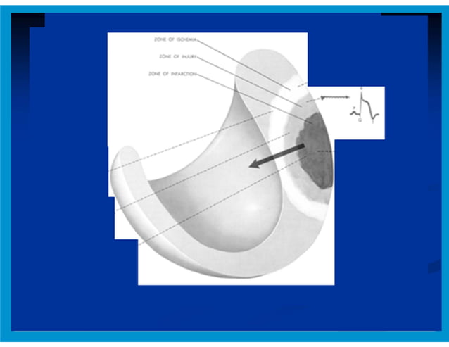 STEMI Training | PPT