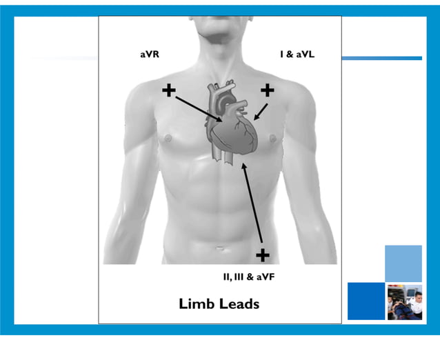 STEMI Training | PPT