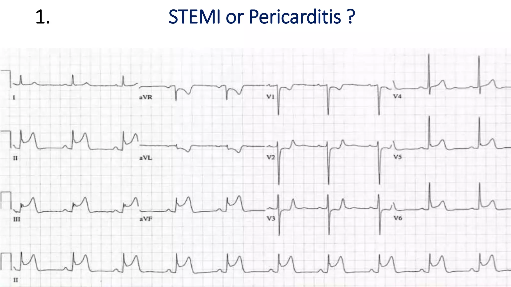 Stemi vs pericarditis ECG diagnosis | PPTX