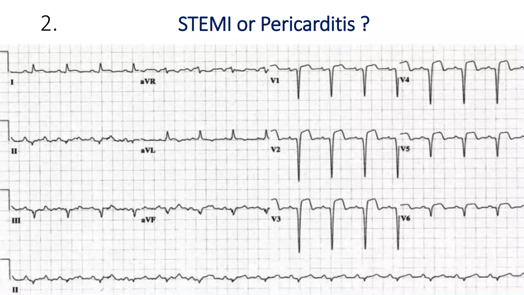 Stemi vs pericarditis ECG diagnosis | PPT
