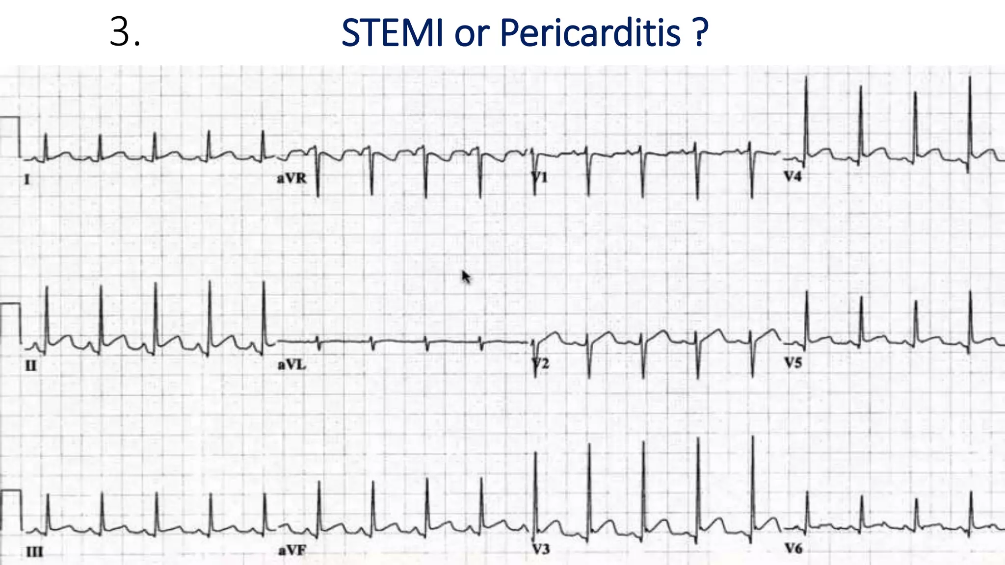 Stemi vs pericarditis ECG diagnosis | PPT