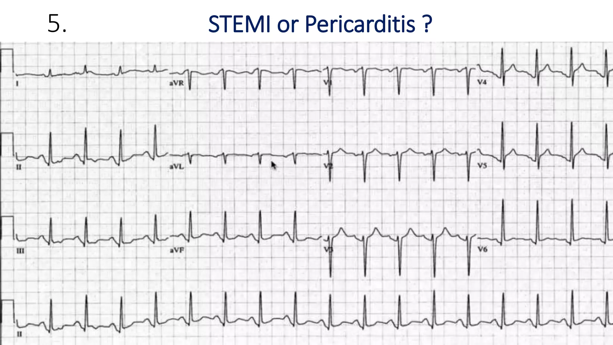 Stemi vs pericarditis ECG diagnosis | PPT