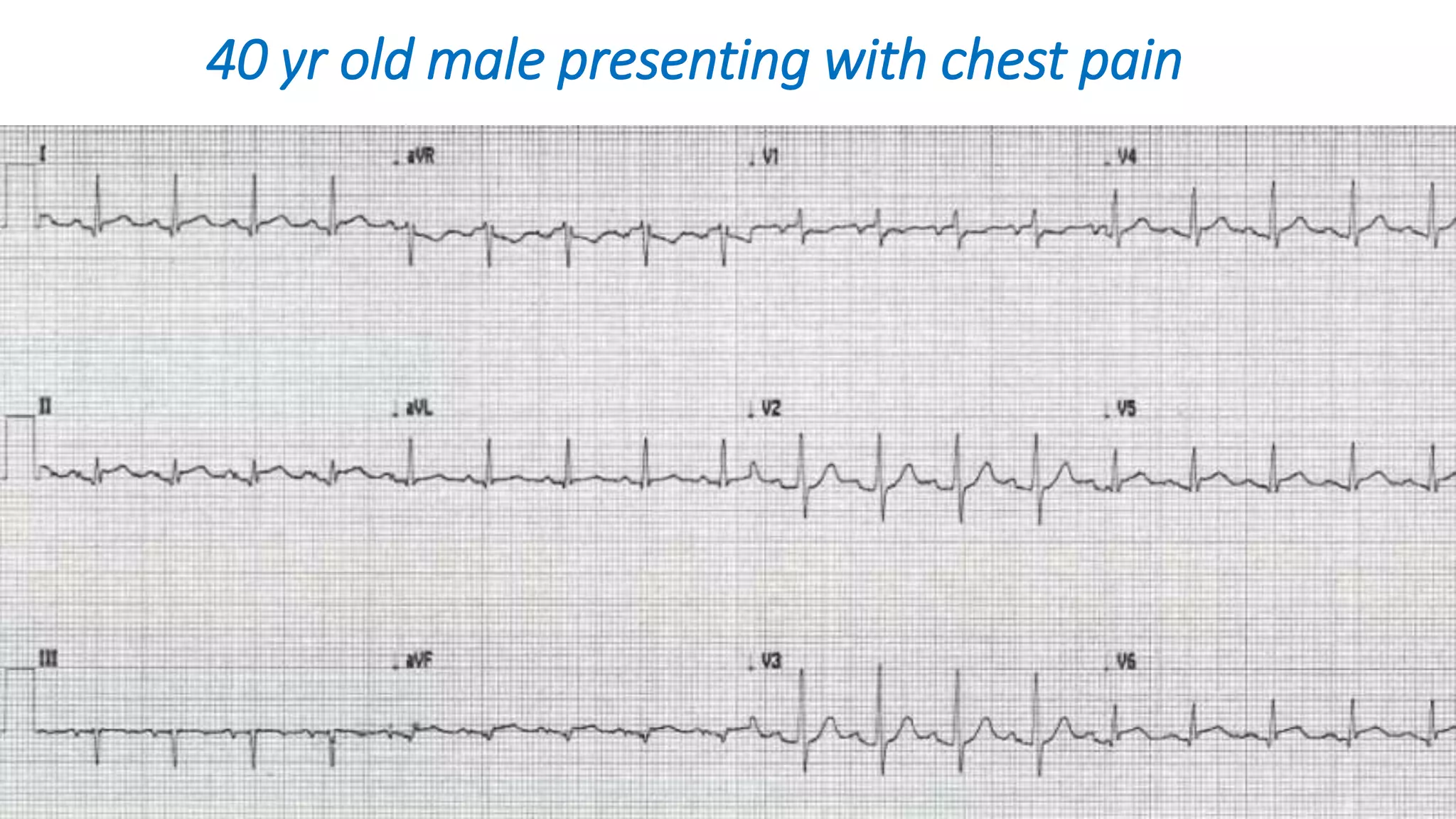 Stemi vs pericarditis ECG diagnosis | PPTX