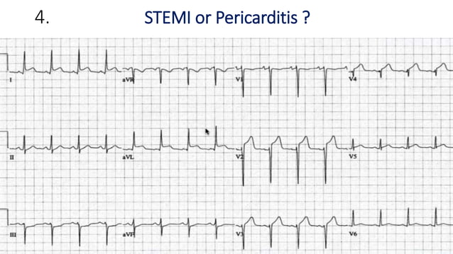 Stemi vs pericarditis ECG diagnosis | PPT