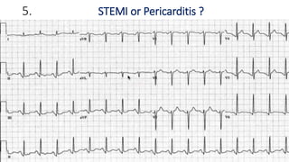 Stemi vs pericarditis ECG diagnosis | PPT