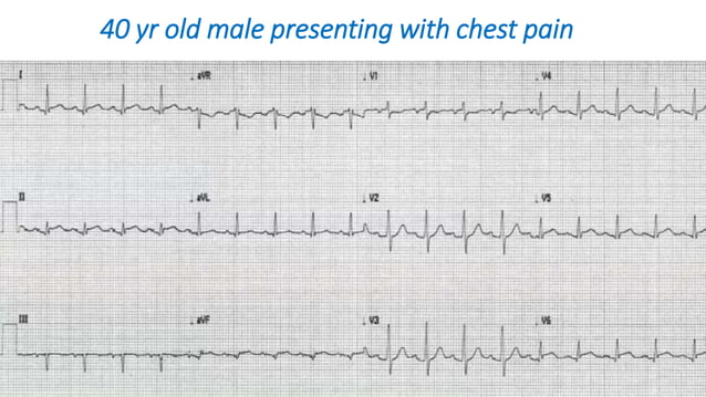 Stemi vs pericarditis ECG diagnosis | PPT