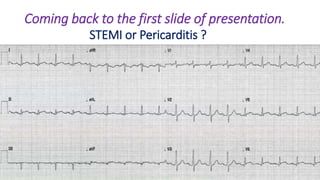 Stemi vs pericarditis ECG diagnosis | PPT