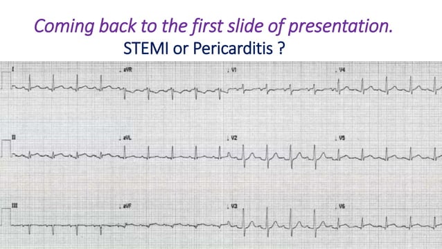 Stemi vs pericarditis ECG diagnosis | PPT