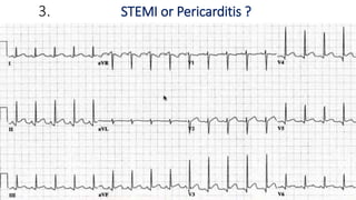 Stemi Vs Pericarditis Ecg