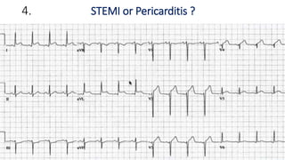 Stemi Vs Pericarditis Ecg