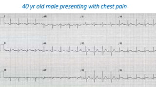Stemi Vs Pericarditis Ecg