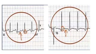 Stemi Vs Pericarditis Ecg