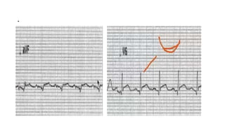 Stemi Vs Pericarditis Ecg