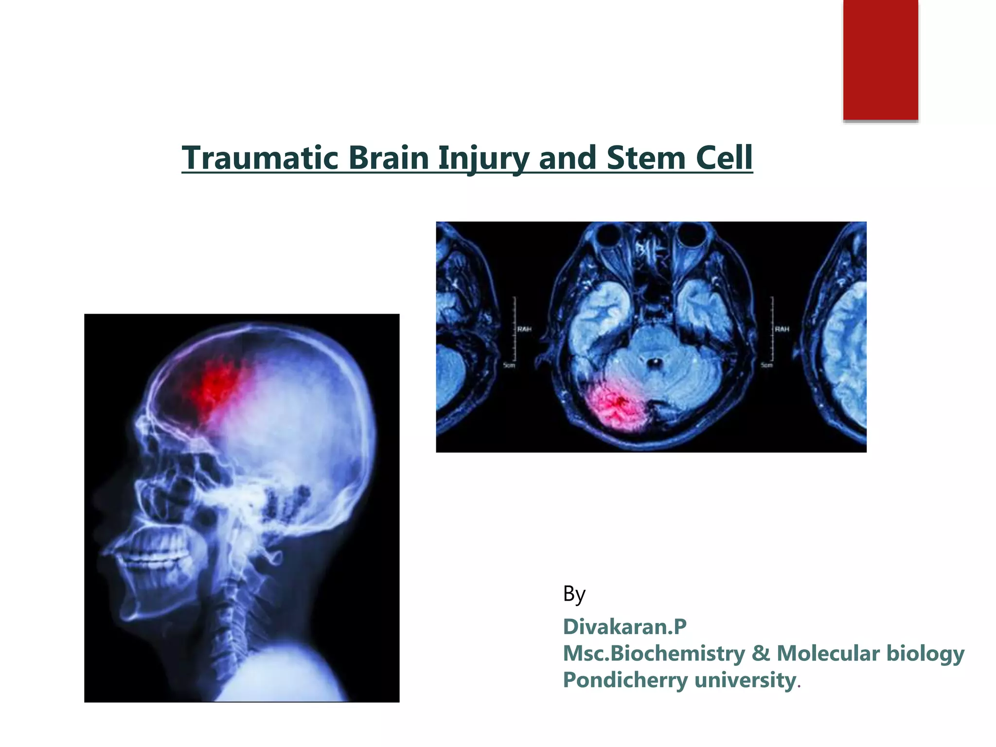 stem cell and Traumatic brain injury | PPT