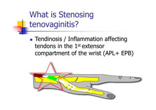 Stenosing tenovaginitis class for orthopedics residents | PPT
