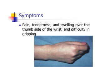 Stenosing tenovaginitis class for orthopedics residents | PPT