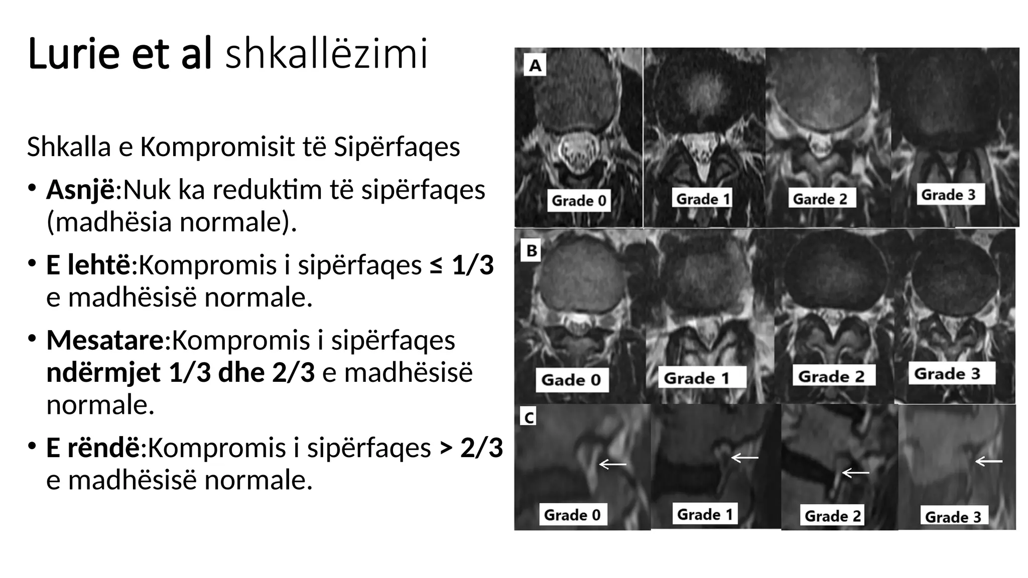 Stenoza spinale lumbare. Dr Haki Selaj QKUK | PPTX