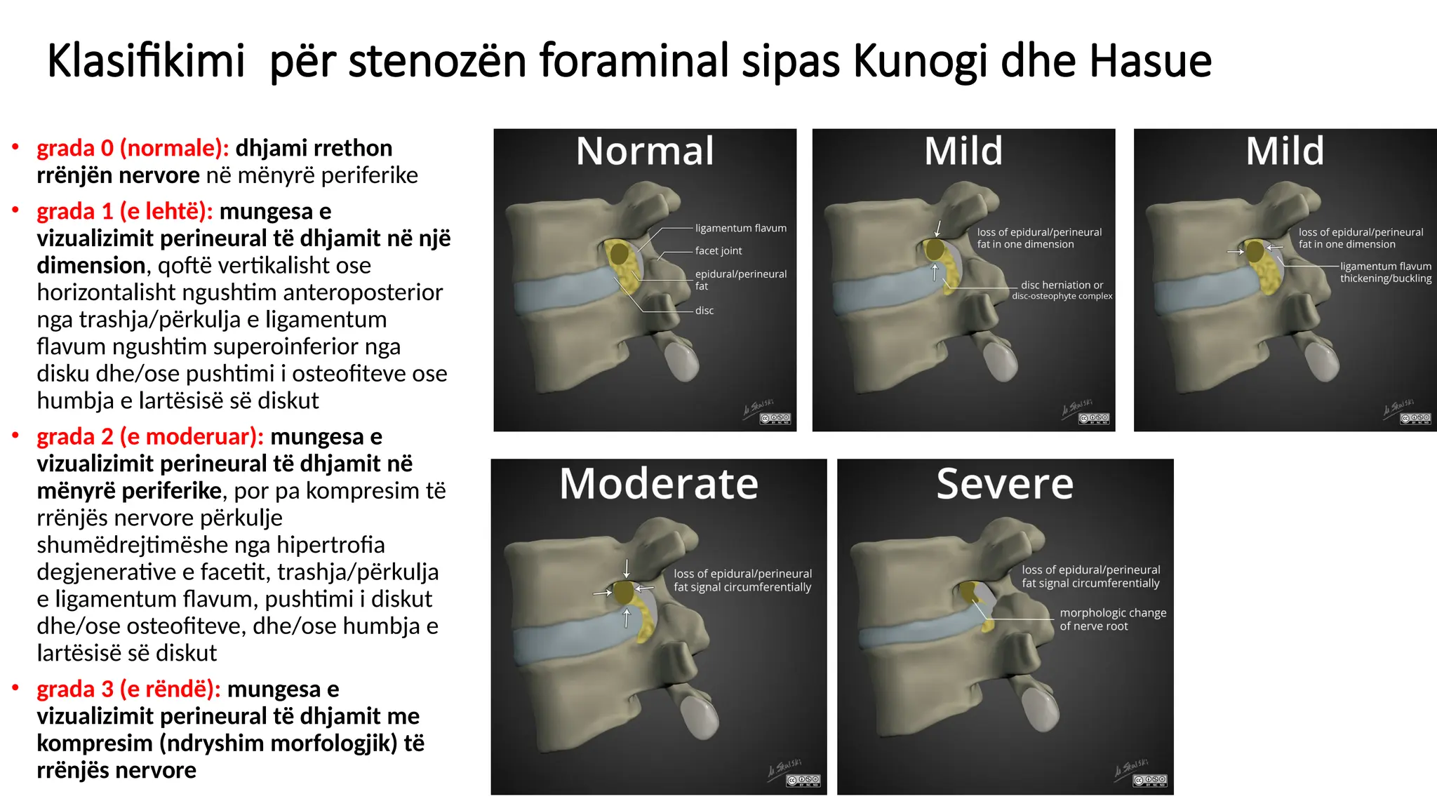 Stenoza spinale lumbare. Dr Haki Selaj QKUK | PPTX