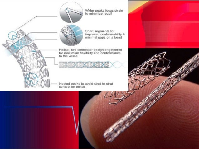 REABSORB : AN ABSORBABLE STENT