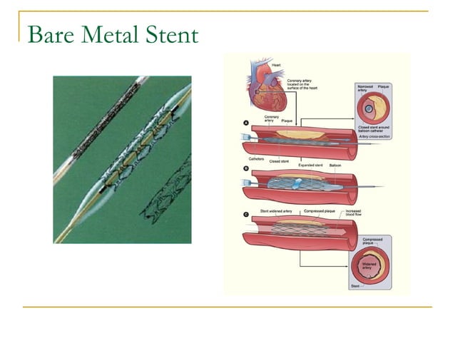 Coronary Stent - Part A - Overview | PPT