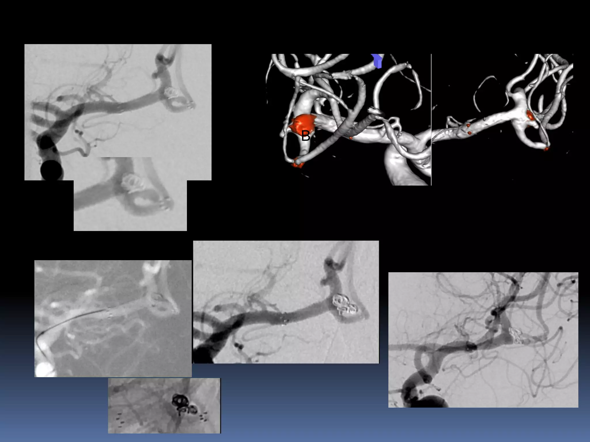 Stent assisted reconstruction of difficult aneurysms in acute ...