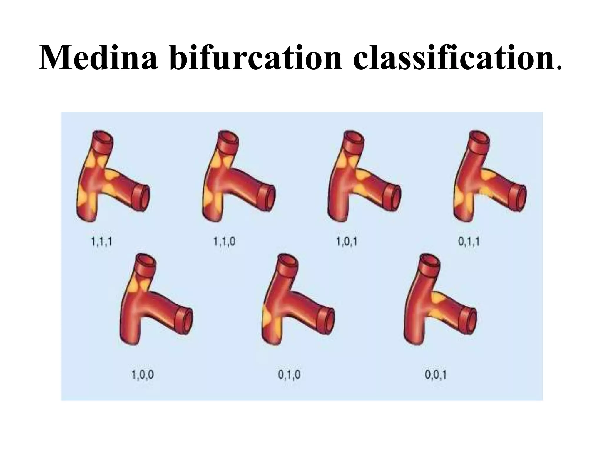 Stenting of bifurcation lesions | PPT
