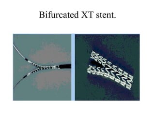 Stenting of bifurcation lesions | PPTX