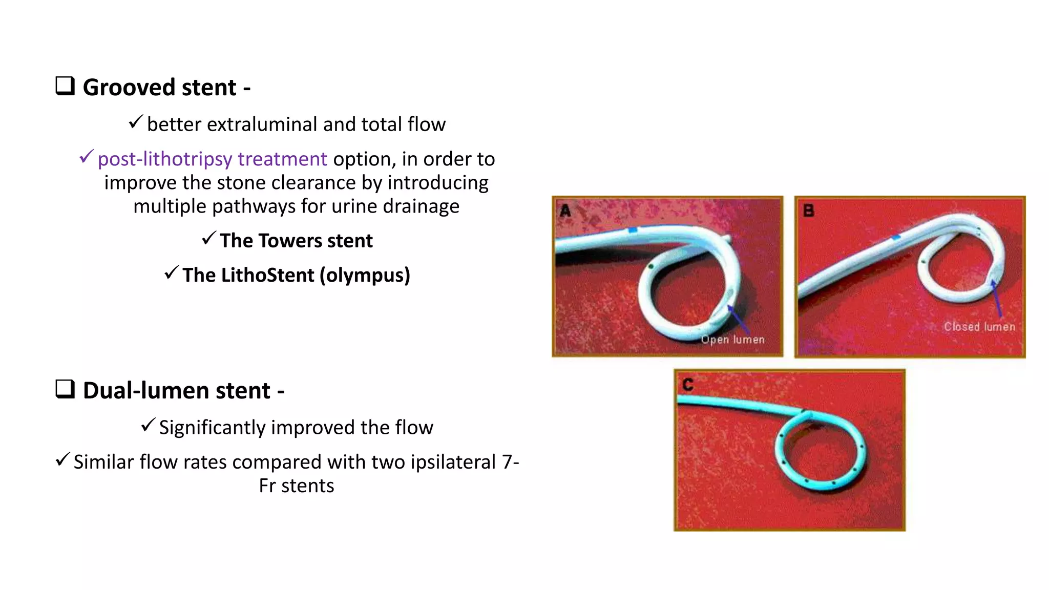 Stents in urology | PPTX