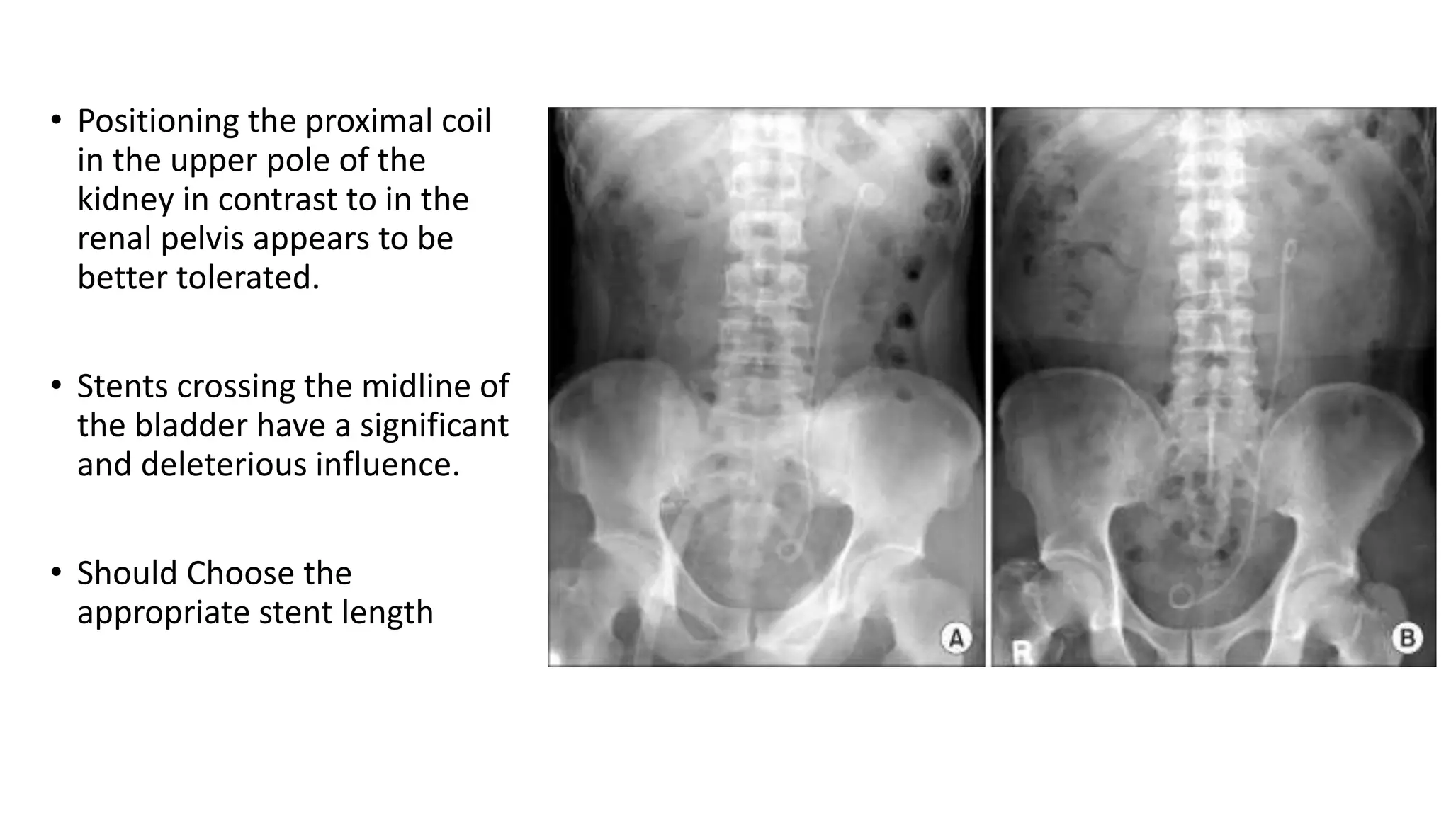 Stents in urology | PPTX
