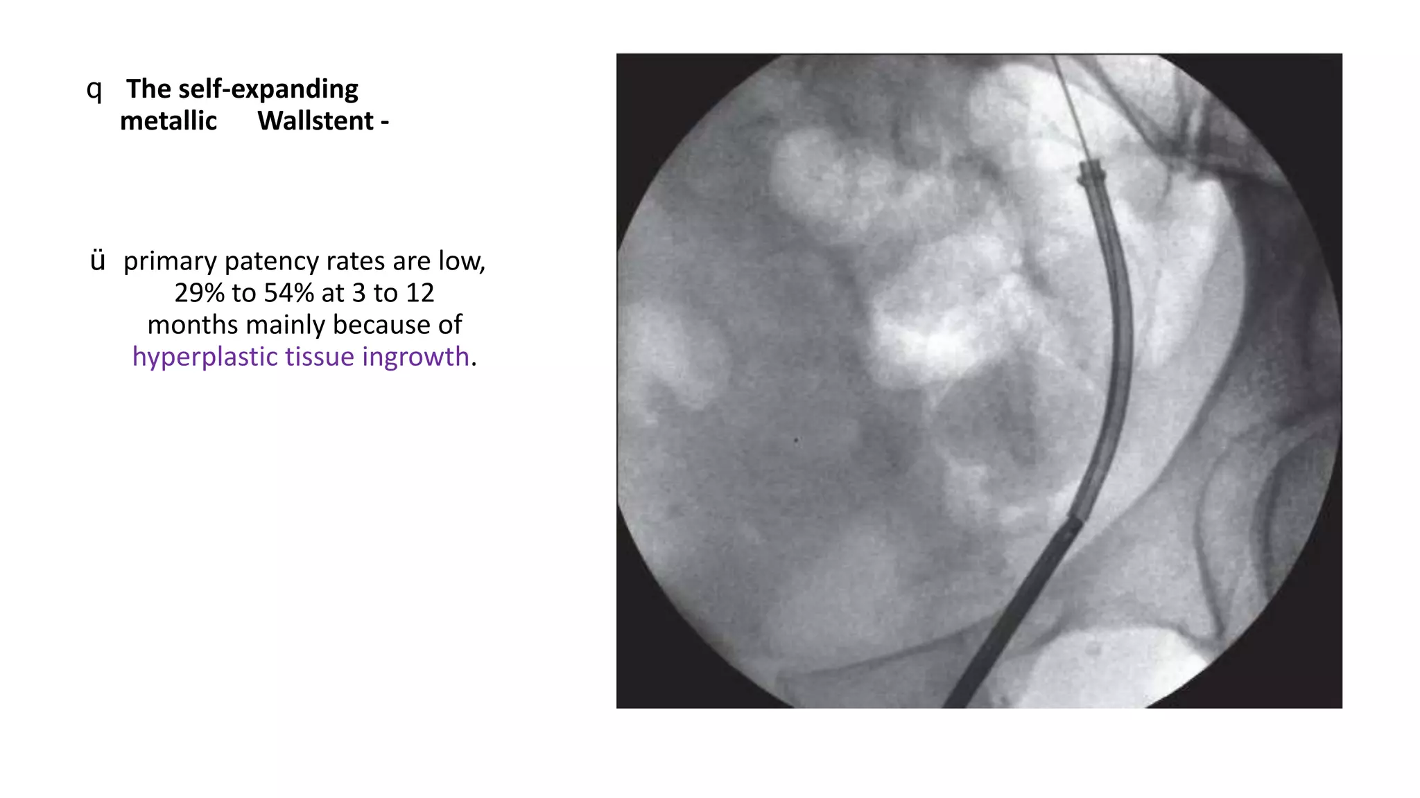 Stents in urology | PPTX