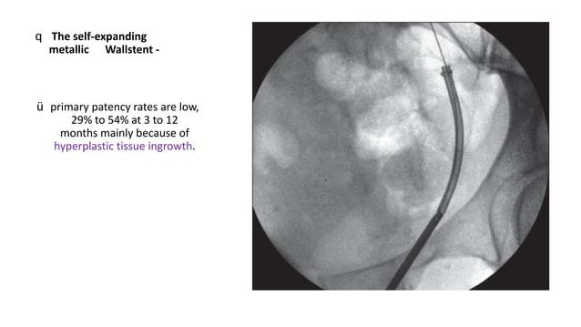 Stents in urology | PPTX | Chemistry | Science