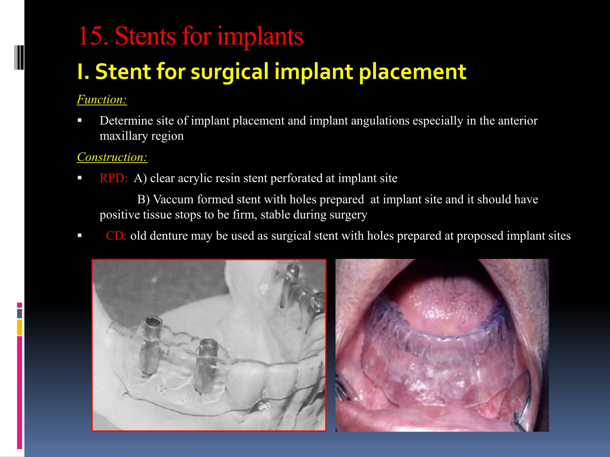 stents-splints.ppt surgical guides ppt s | PPT