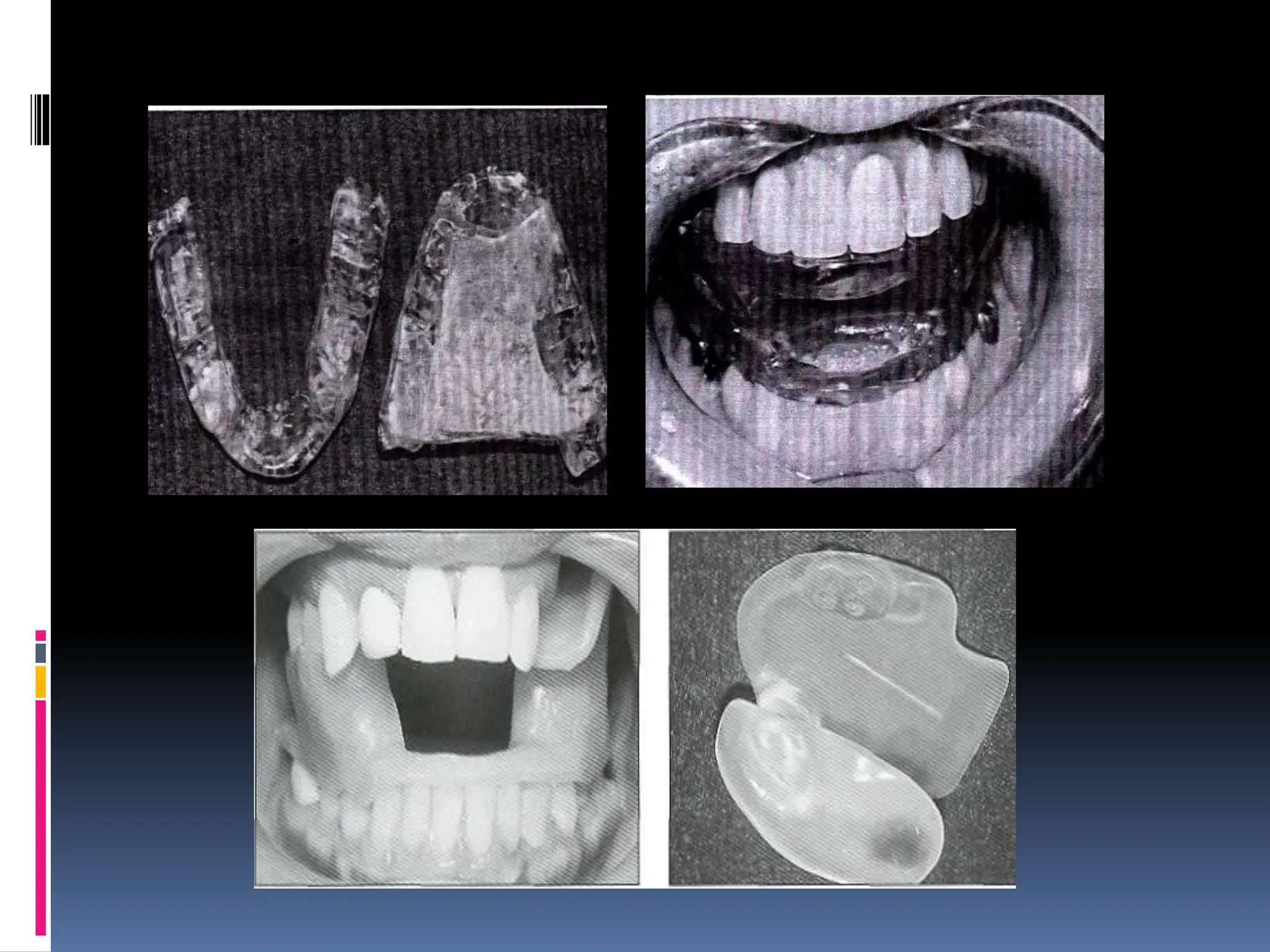 stents-splints.ppt surgical guides ppt s | PPT