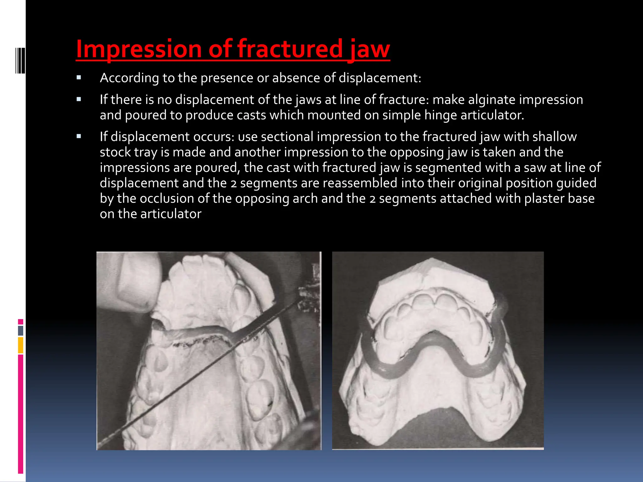 stents-splints.ppt surgical guides ppt s | PPT