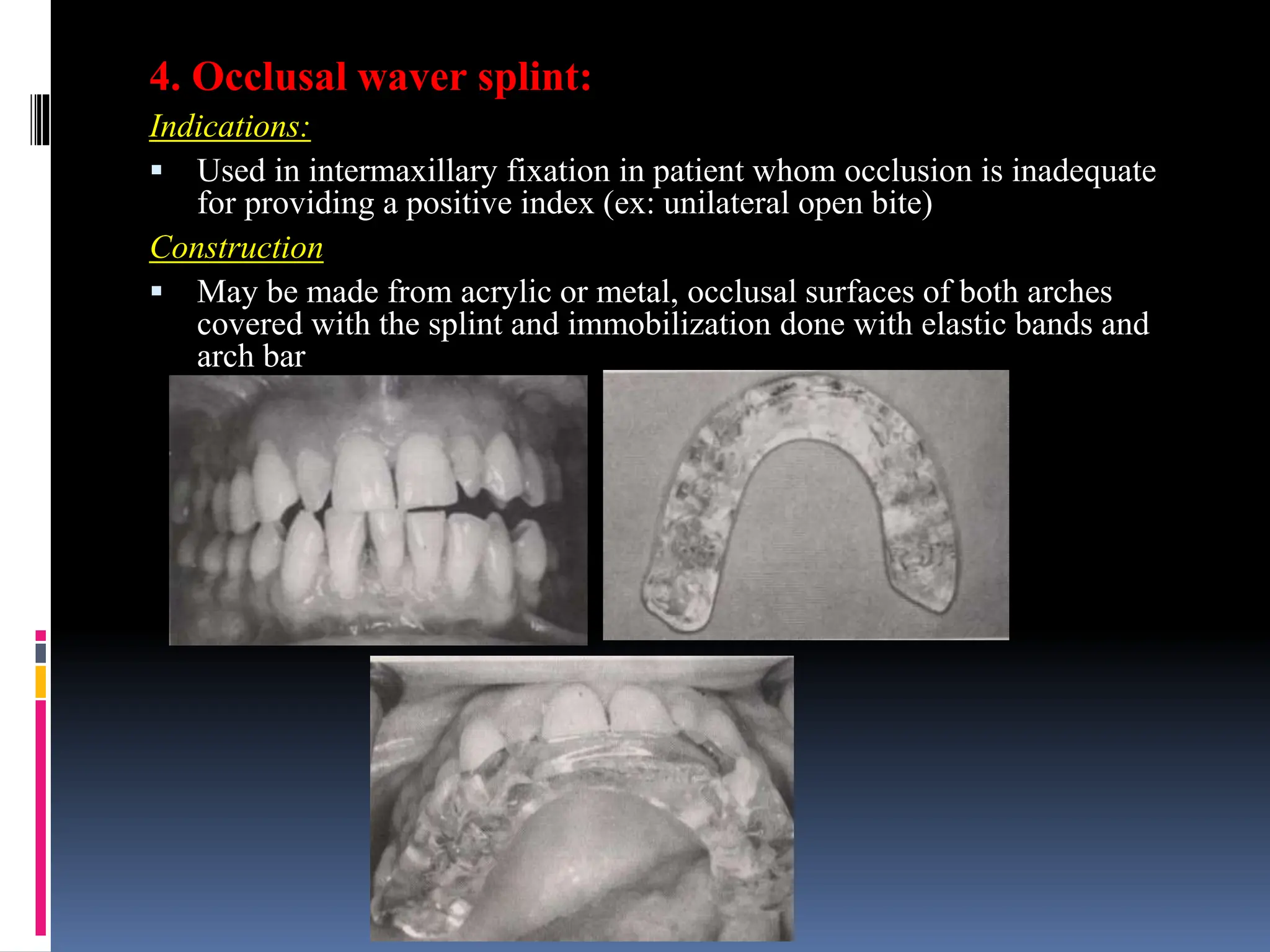 stents-splints.ppt surgical guides ppt s | PPT