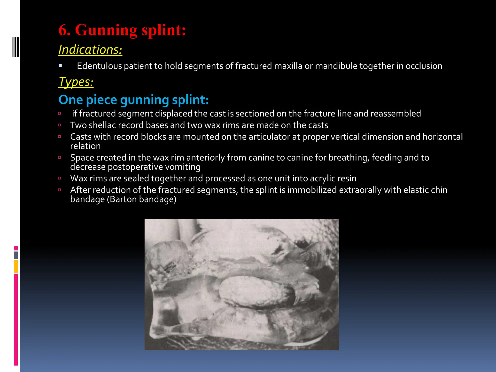 stents-splints.ppt surgical guides ppt s | PPT