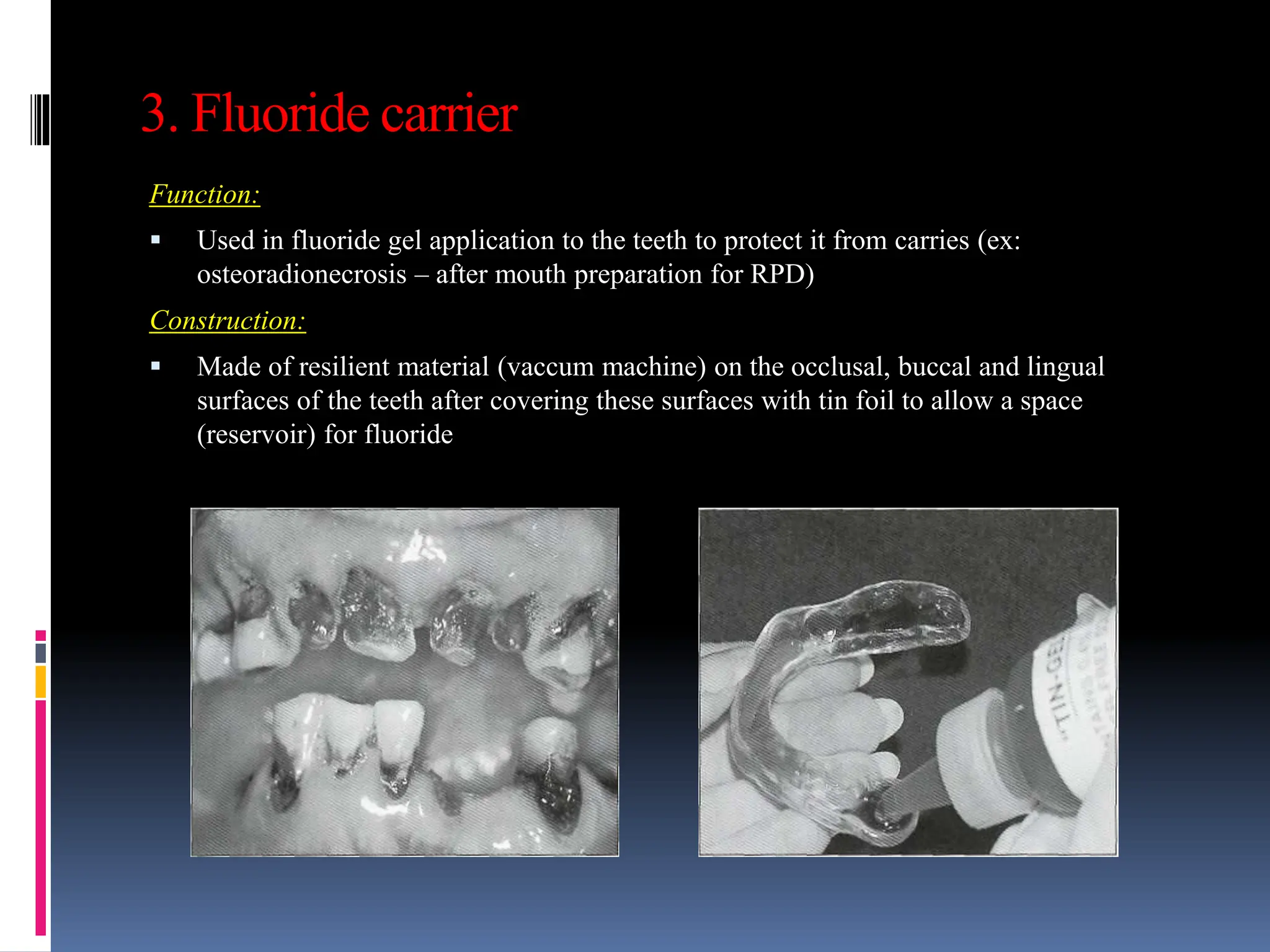 stents-splints.ppt surgical guides ppt s | PPT