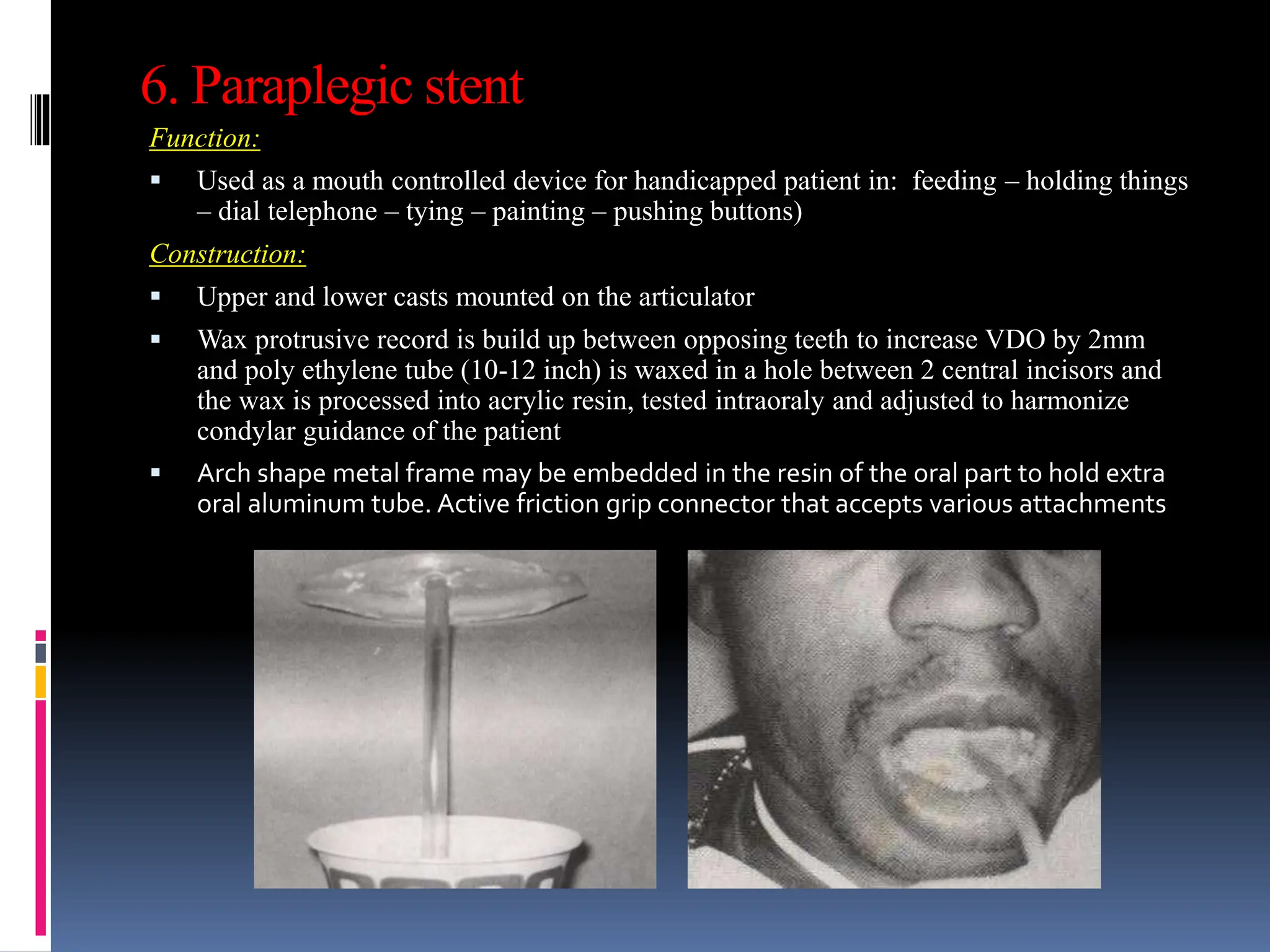 stents-splints.ppt surgical guides ppt s | PPT