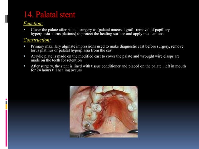 stents-splints.ppt surgical guides ppt s | PPT | Dental Health ...