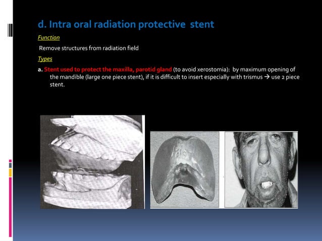 stents-splints.ppt surgical guides ppt s | PPT | Dental Health ...
