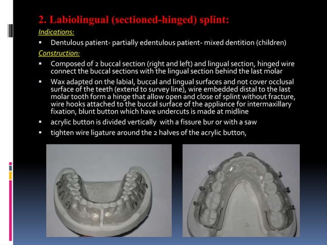 stents-splints.ppt surgical guides ppt s | PPT | Dental Health ...