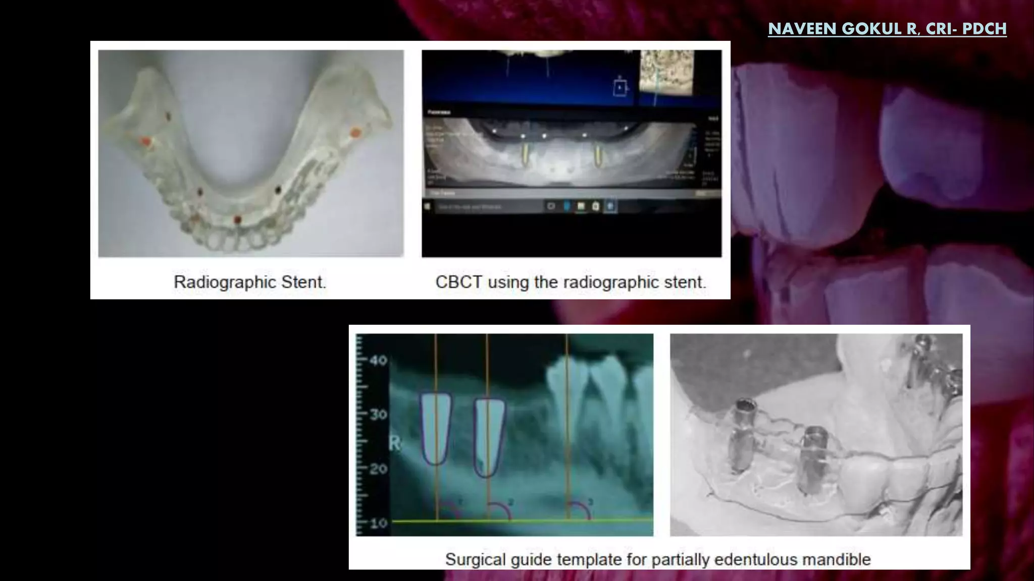 STENTS AND SPLINTS IN PROSTHODONTICS | PPTX