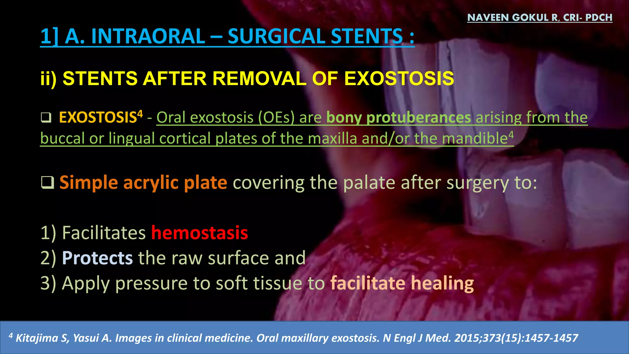 STENTS AND SPLINTS IN PROSTHODONTICS | PPTX