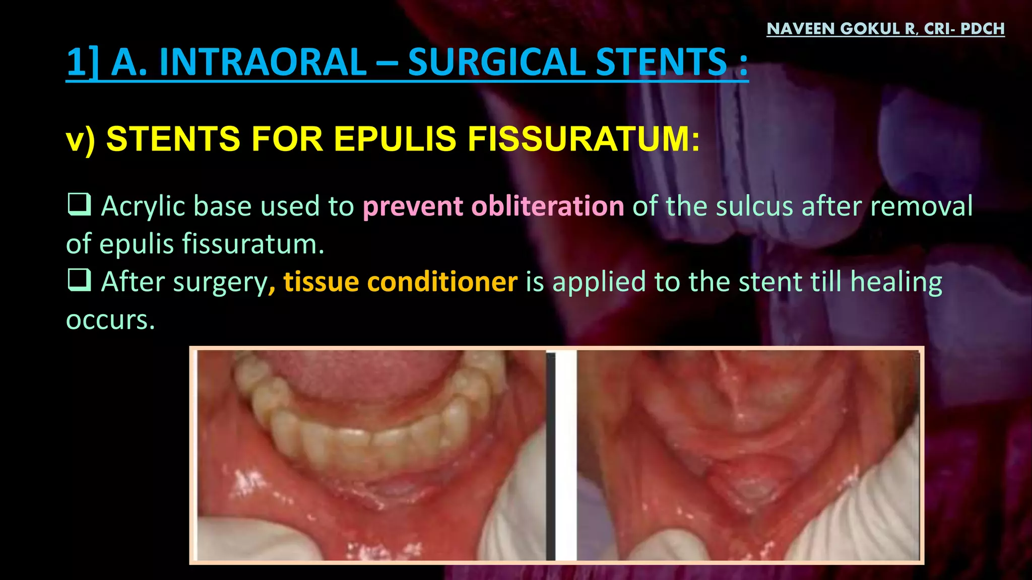 STENTS AND SPLINTS IN PROSTHODONTICS | PPTX
