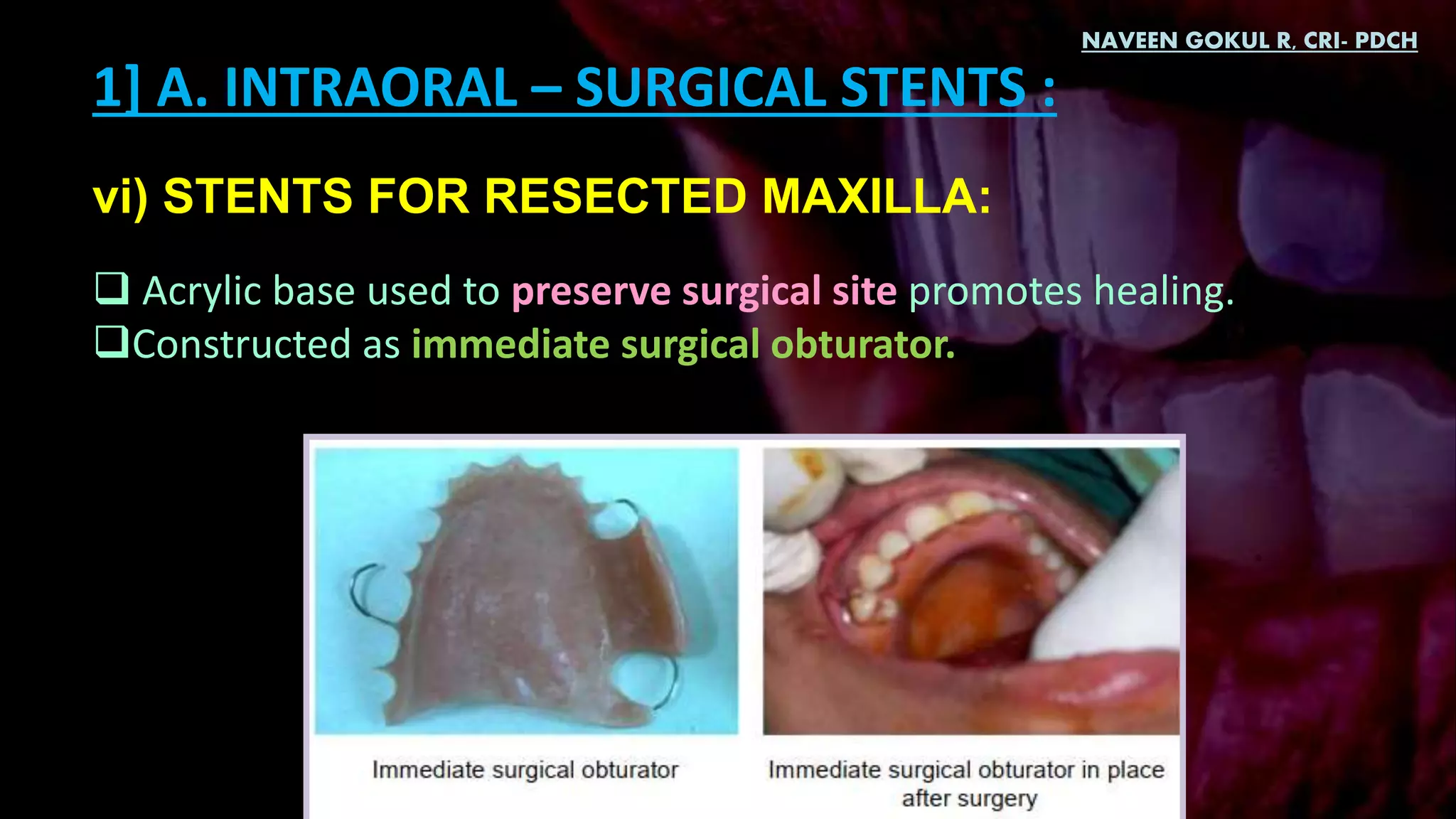 STENTS AND SPLINTS IN PROSTHODONTICS | PPTX