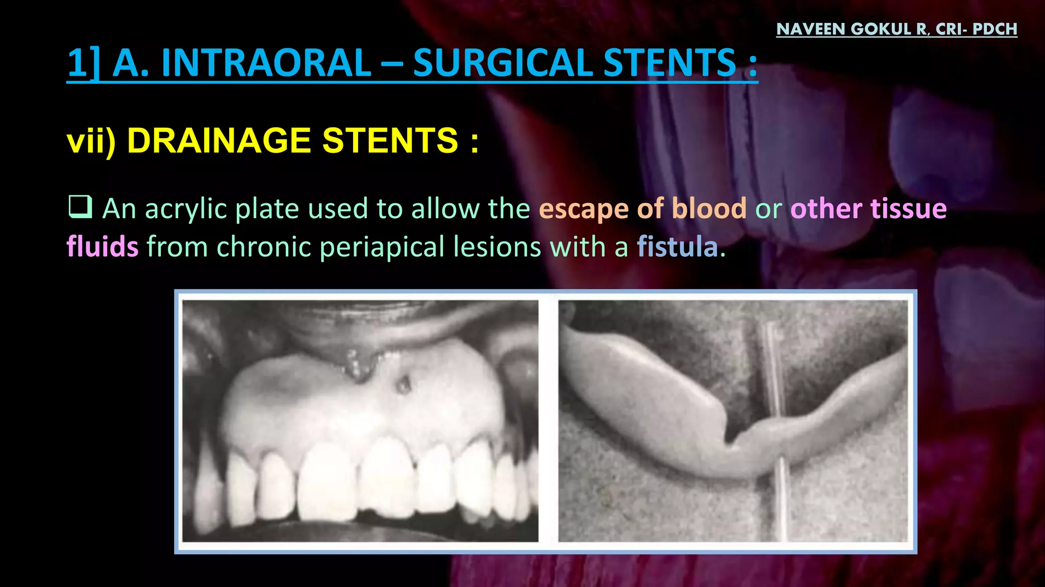 STENTS AND SPLINTS IN PROSTHODONTICS | PPTX