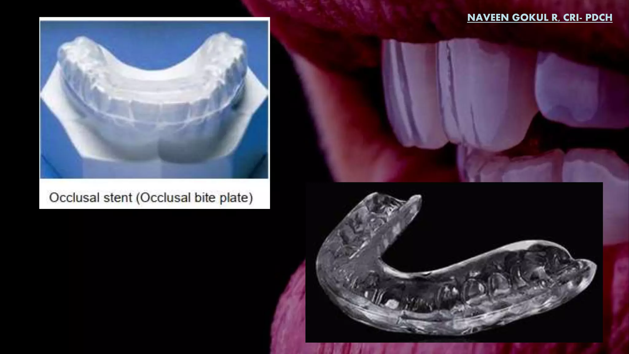 STENTS AND SPLINTS IN PROSTHODONTICS | PPTX