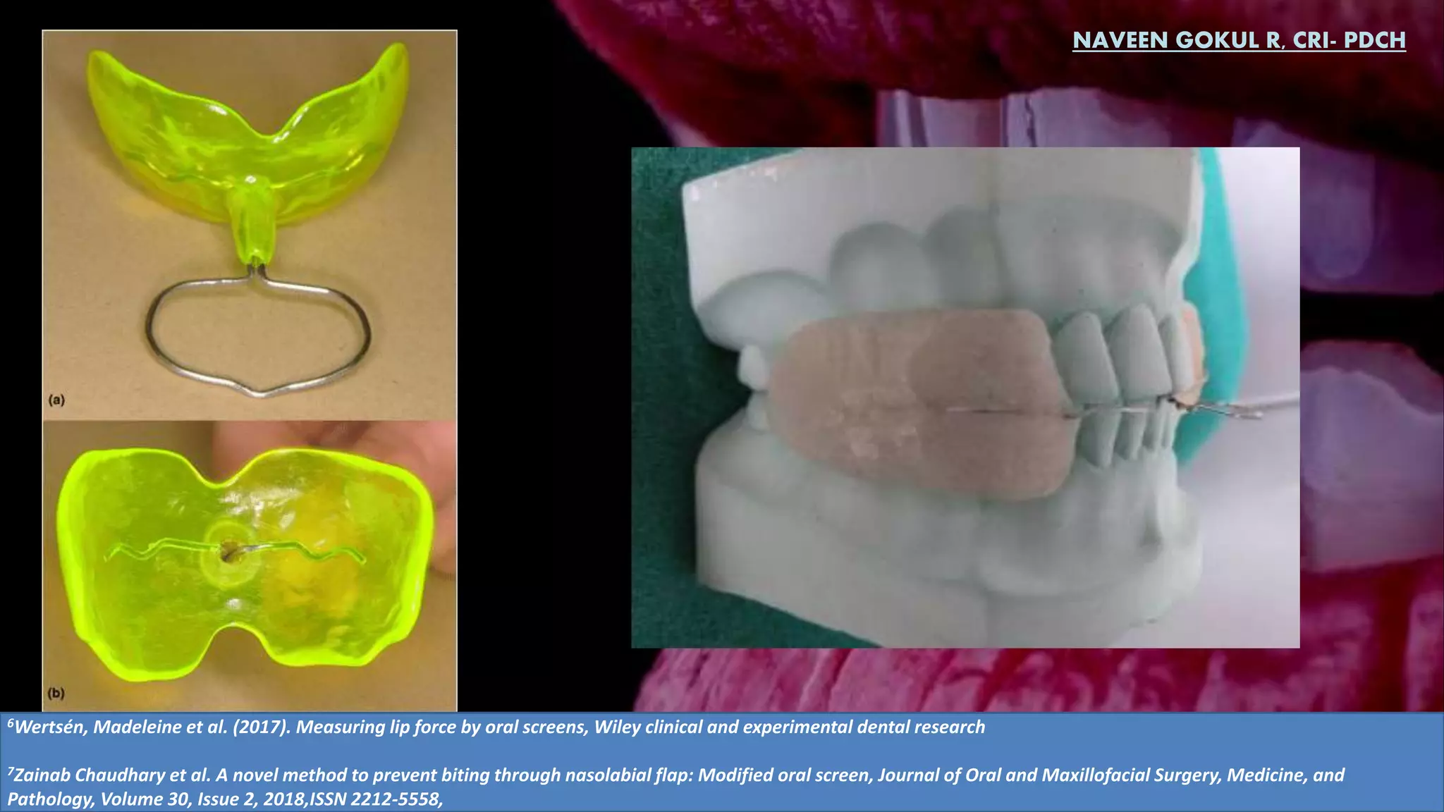 STENTS AND SPLINTS IN PROSTHODONTICS | PPTX
